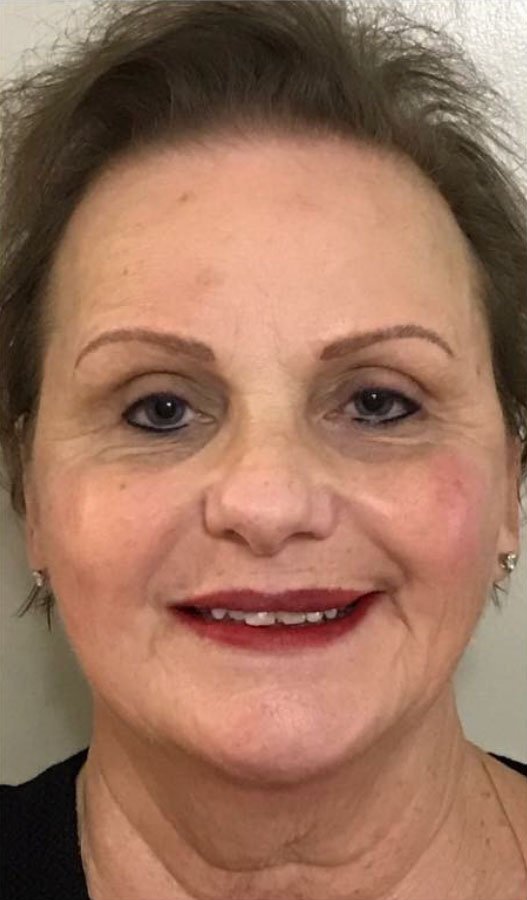 Advanced Cosmetic Techniques - Natchitoches, LA - Full Faces