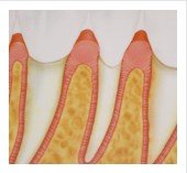 Gingivitis, Gum Inflamation, Gingivitis Treatment, orwood Dentist ...