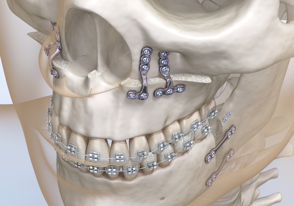 Orthognathic Surgery Oral Maxillofacial Surgeon Toowoomba