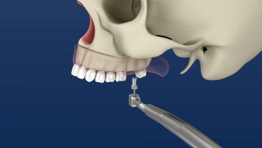 Sinus Lifts | Cosmetic Surgeon | Toowoomba