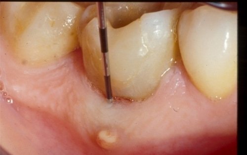 Tooth devitalisation - Bologna - Multidisciplinary dental centre