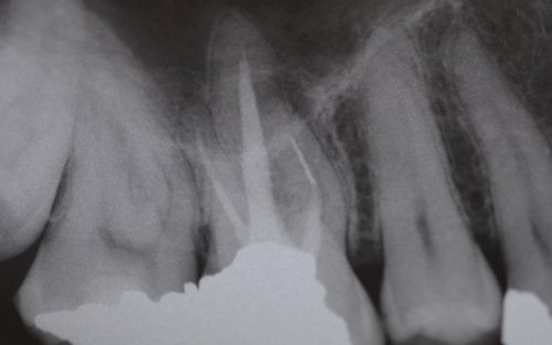 Tooth devitalisation - Bologna - Multidisciplinary dental centre