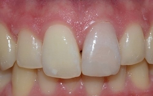 Frattura denti - Bologna - Centro Odontoiatrico Multidisciplinare