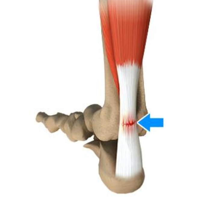 Achilles Tendon Rupture | Bowral Orthopaedics