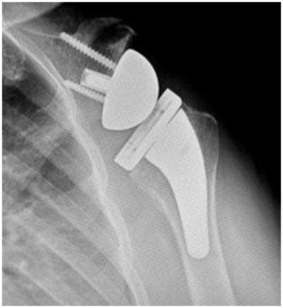 Shoulder Replacement | Bowral Orthopaedics