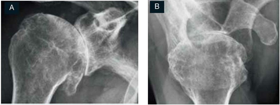Shoulder Arthritis | Bowral Orthopaedics