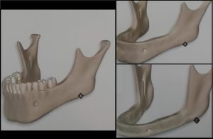 Perda óssea dentária