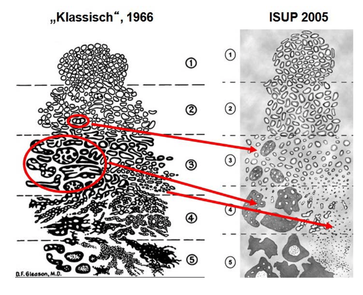 Die Histologie - Grundlage der Therapieempfehlung