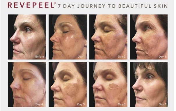Chemical Peel
