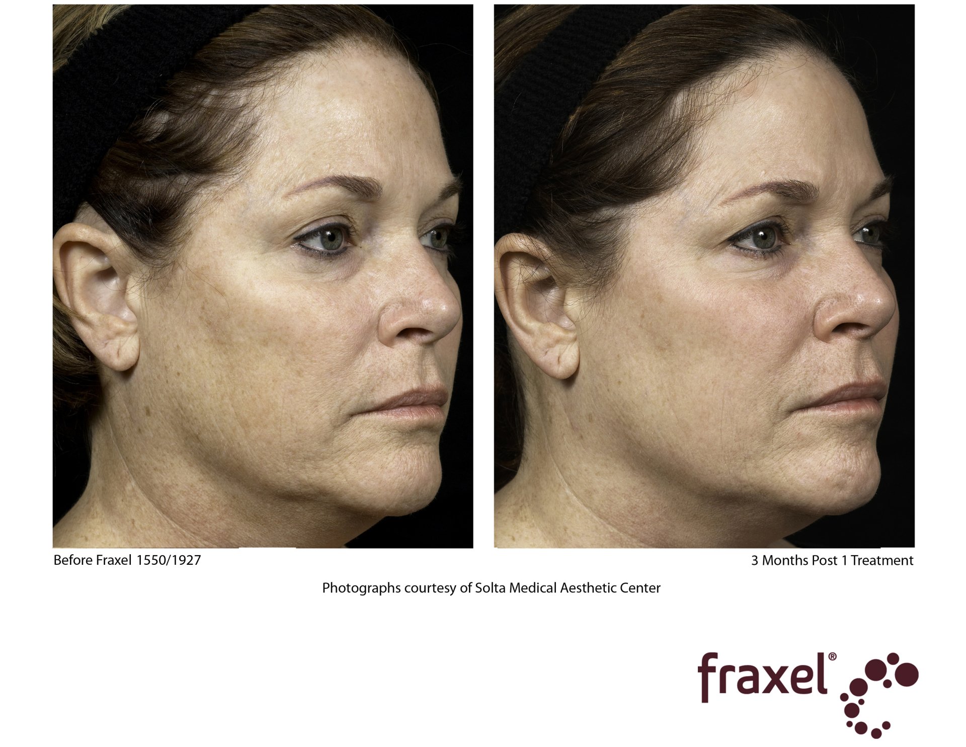 Cosmetic Dermatology in Santa Monica | MedSpa Services