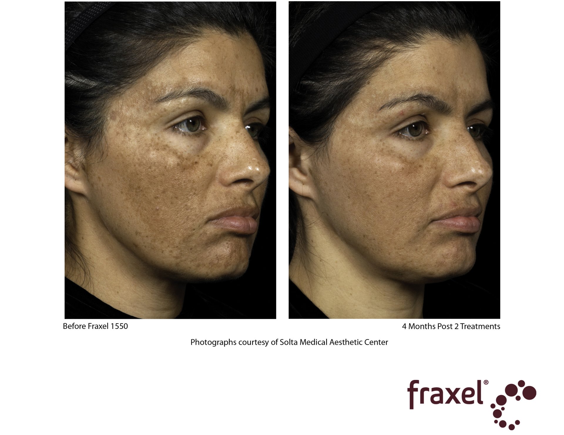 Cosmetic Dermatology in Santa Monica | MedSpa Services