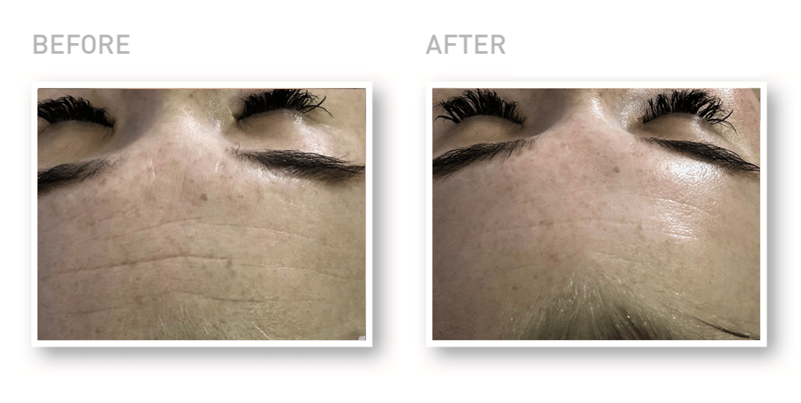 PRX-T33 Treatments in Chicago | Dr. Yates Lifestyle Med Spa