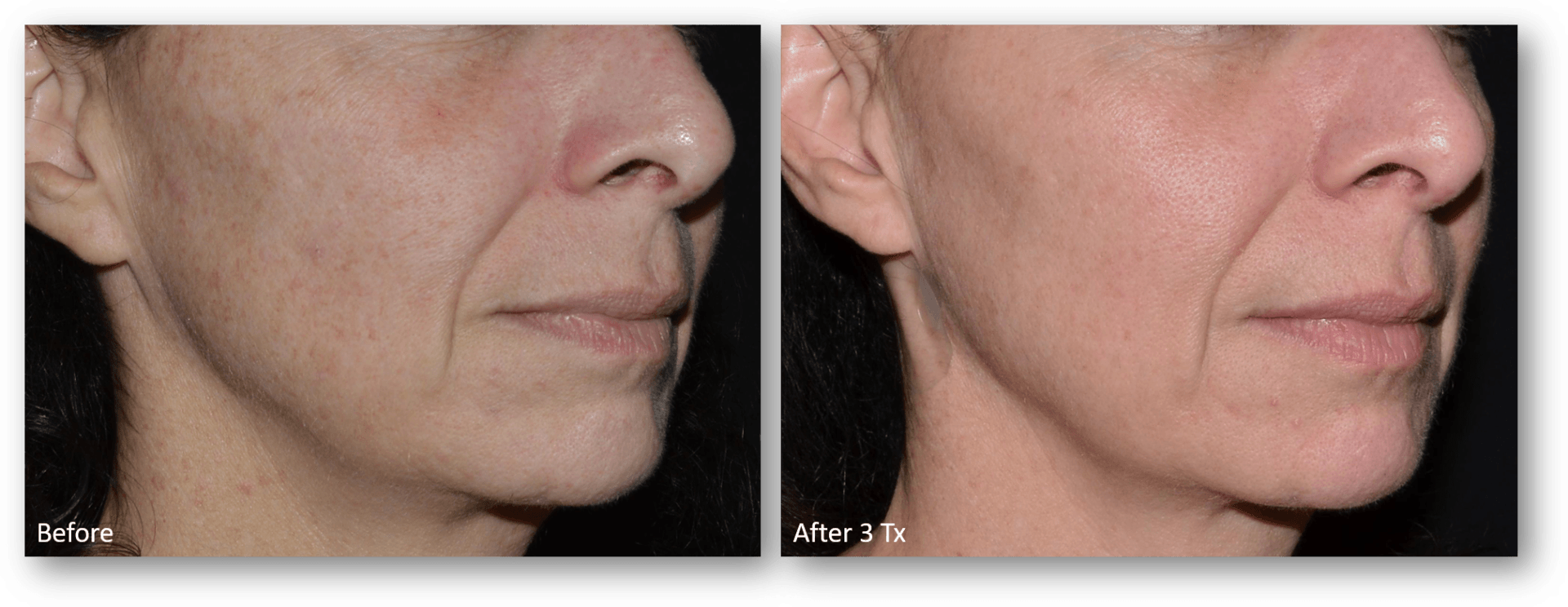 Chicago, IL Laser Resurfacing Services | Dr. Yates Lifestyle Med Spa