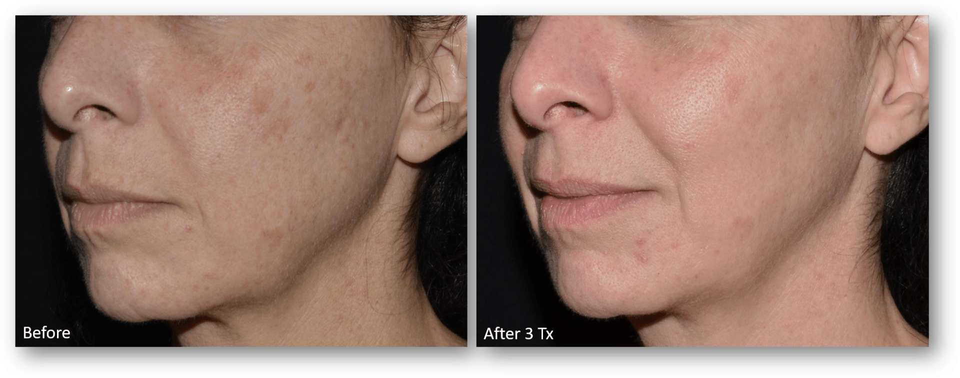 Chicago, IL Laser Resurfacing Services | Dr. Yates Lifestyle Med Spa
