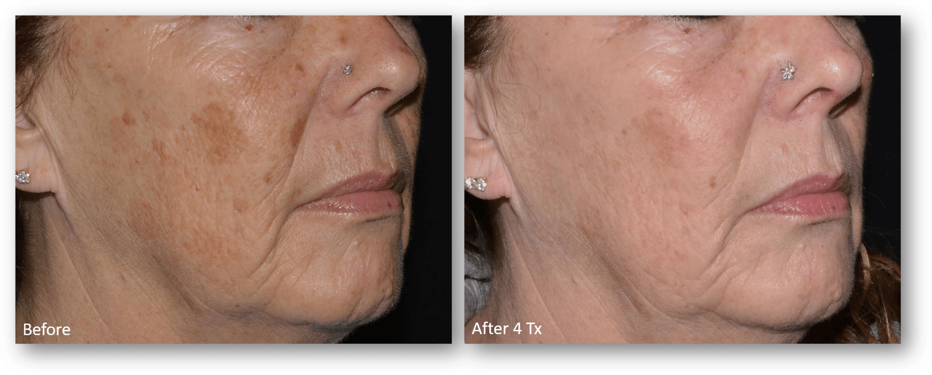 Chicago, IL Laser Resurfacing Services | Dr. Yates Lifestyle Med Spa