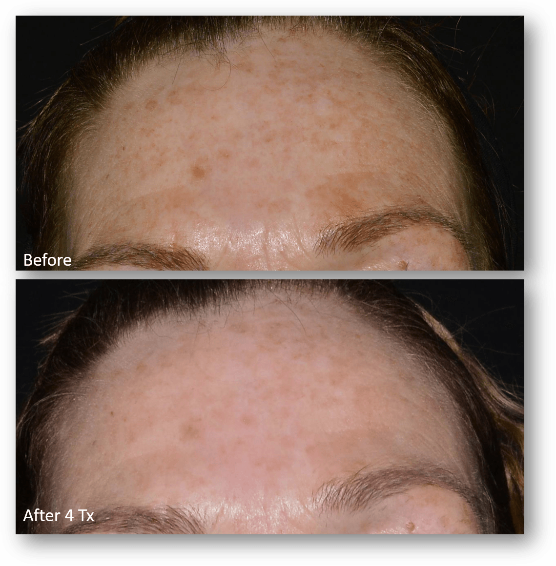 Chicago, IL Laser Resurfacing Services | Dr. Yates Lifestyle Med Spa