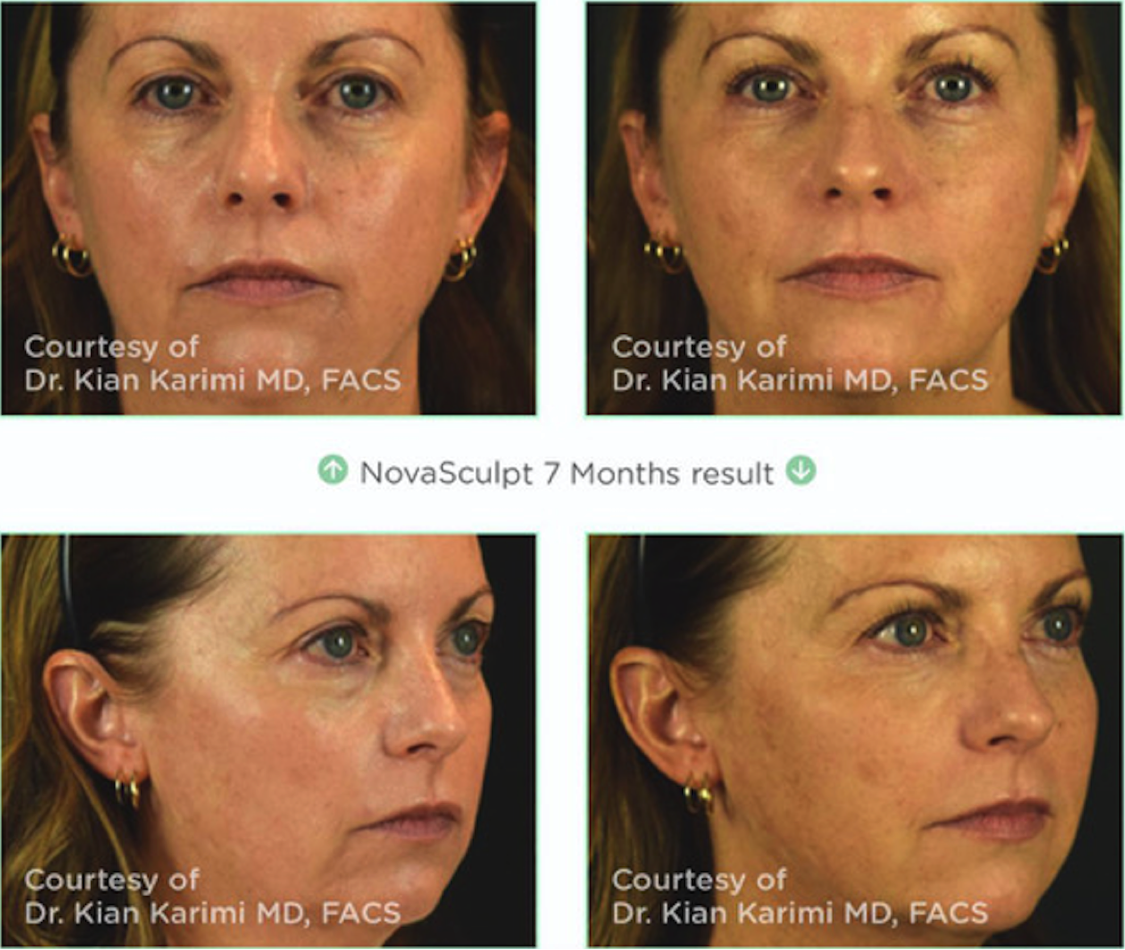 Chicago, IL NovaThreads Procedure | Dr. Yates Lifestyle Med