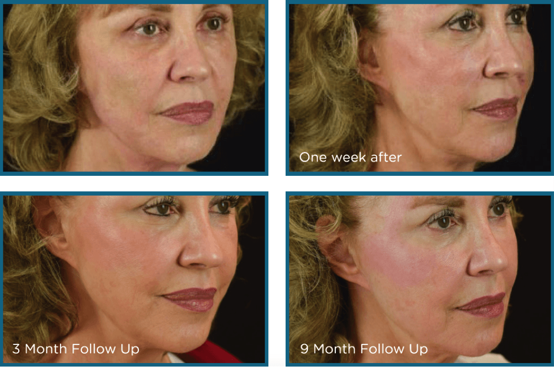 Chicago, IL NovaThreads Procedure | Dr. Yates Lifestyle Med