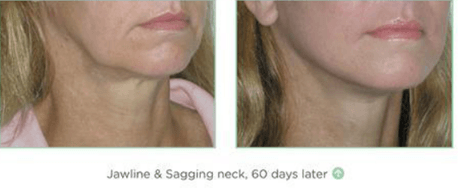 Chicago, IL NovaThreads Procedure | Dr. Yates Lifestyle Med