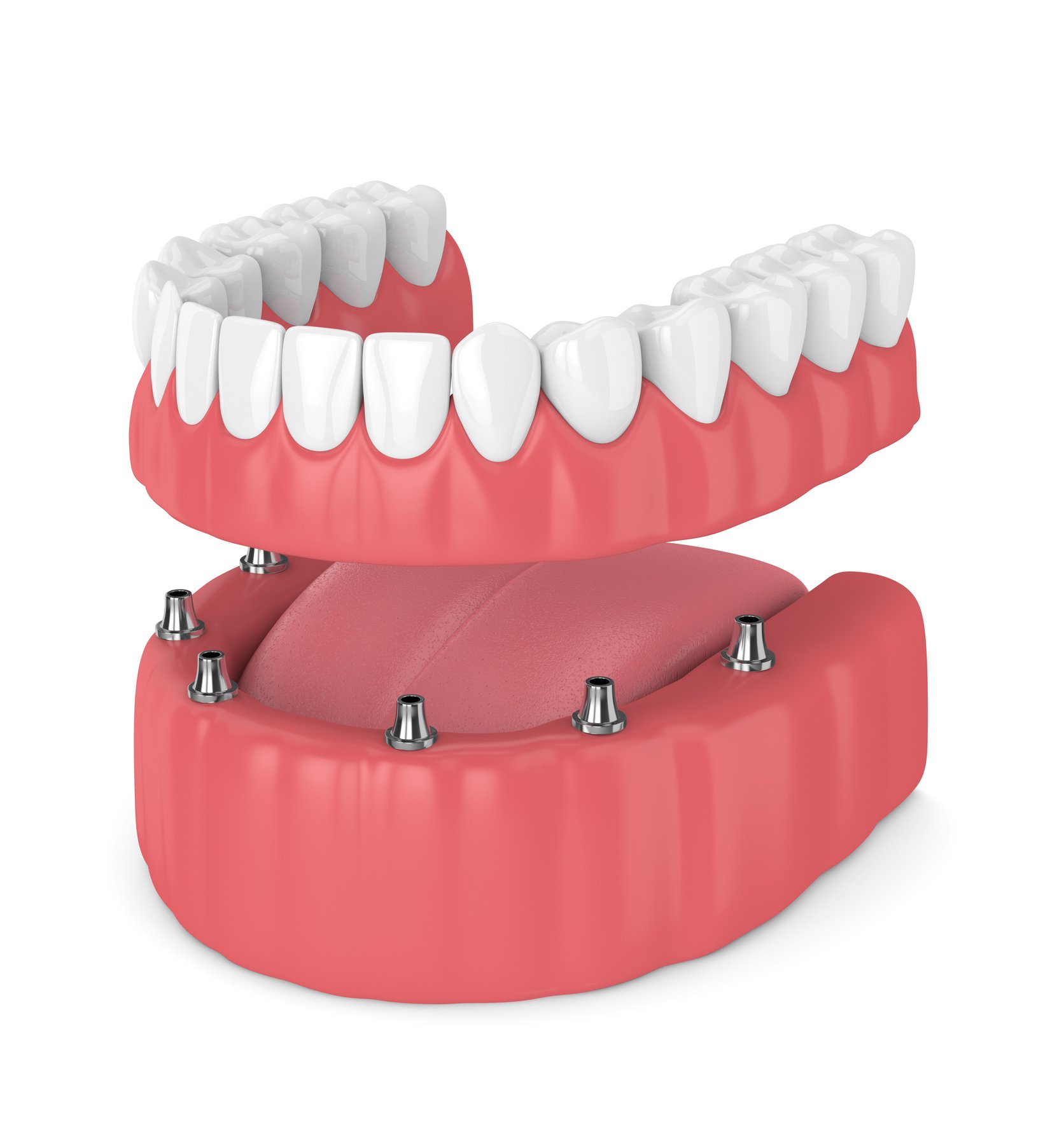 Complete Dentures | Newport News, VA | Tidewater Prostho