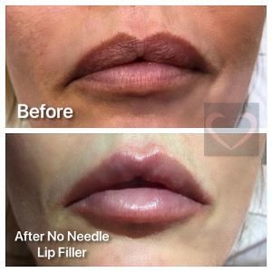 No Needle Filler - The Vault, Wye, Ashford, Kent