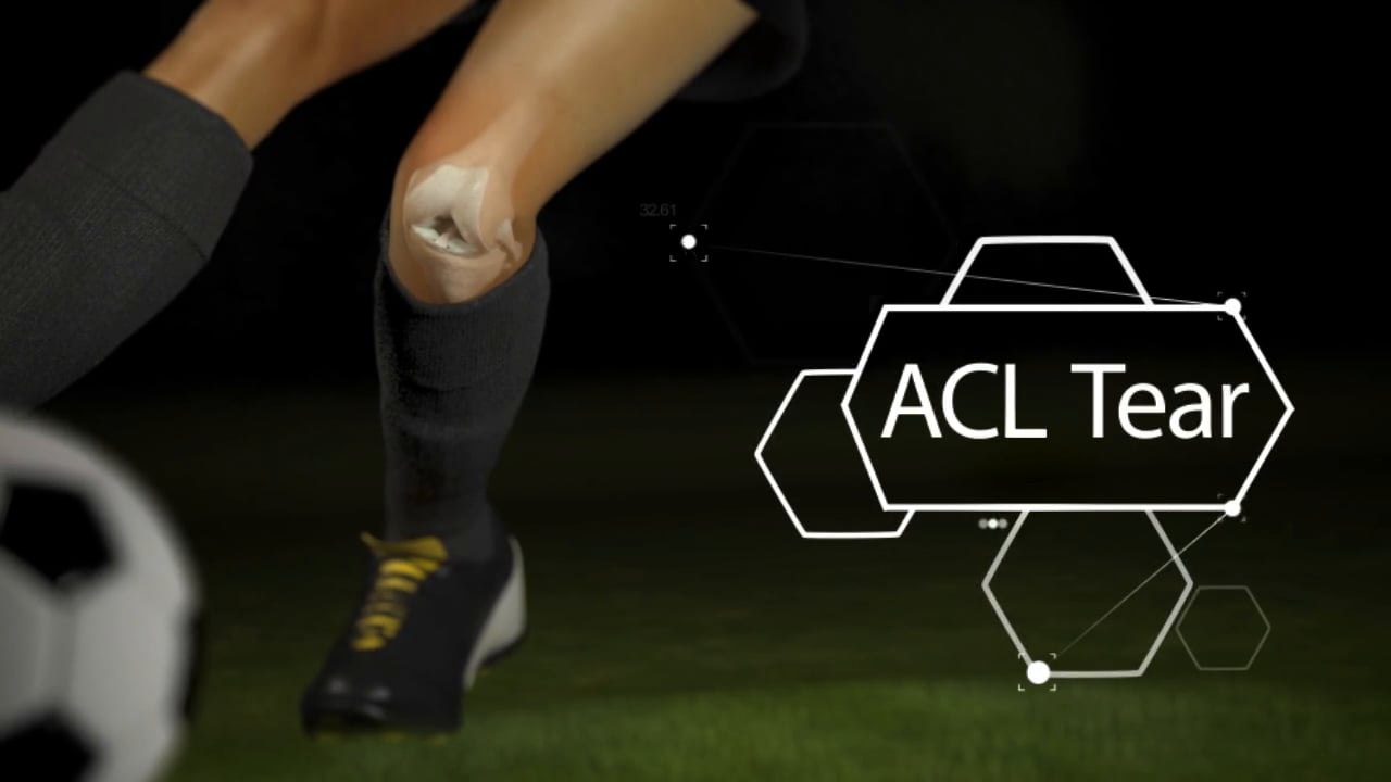 ACL Tear and Injury Management for An Athlete