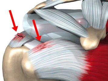 Rotator Cuff Injury and Rehabilitation