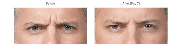 Dermal Fillers in Jacksonville, FL