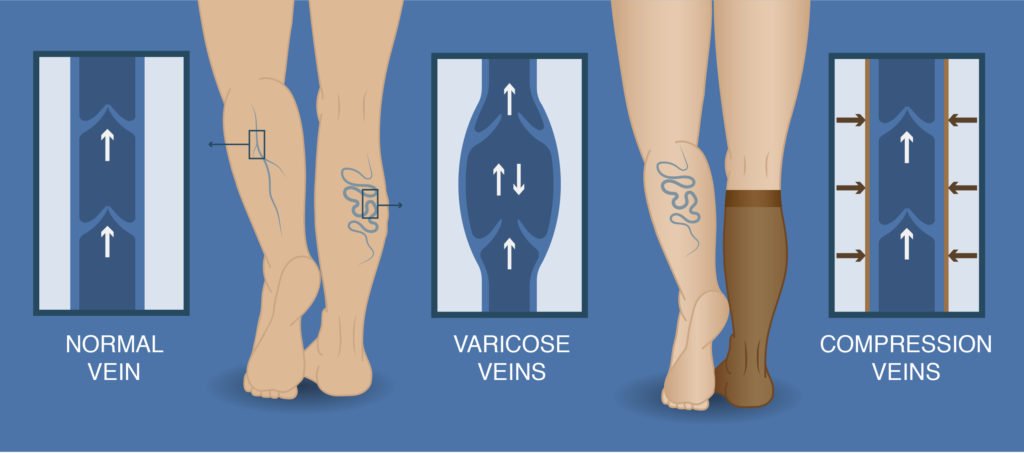 Vein Treatment | Ponte Vedra Vein & Aesthetics | Jax