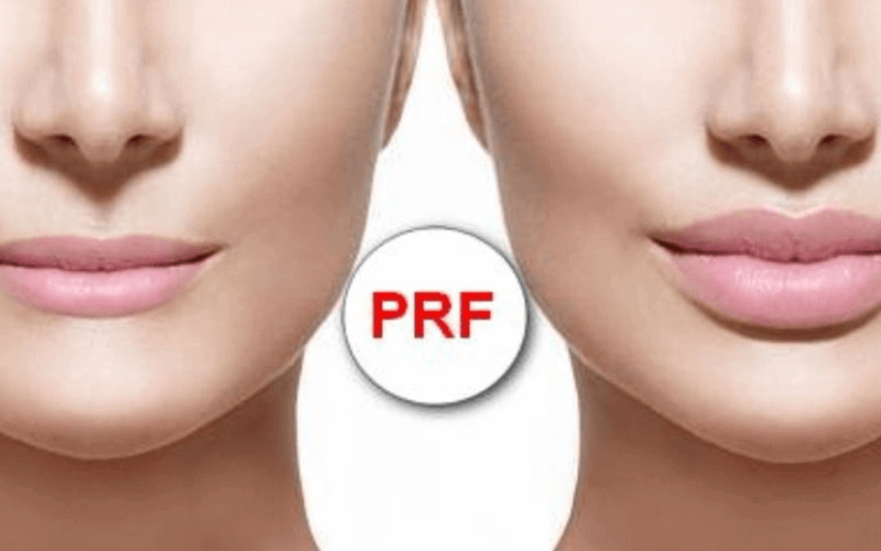 Facial skin rejuvenation method - iPRF procedure