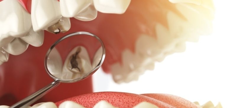 What is an Occlusal Cavity?