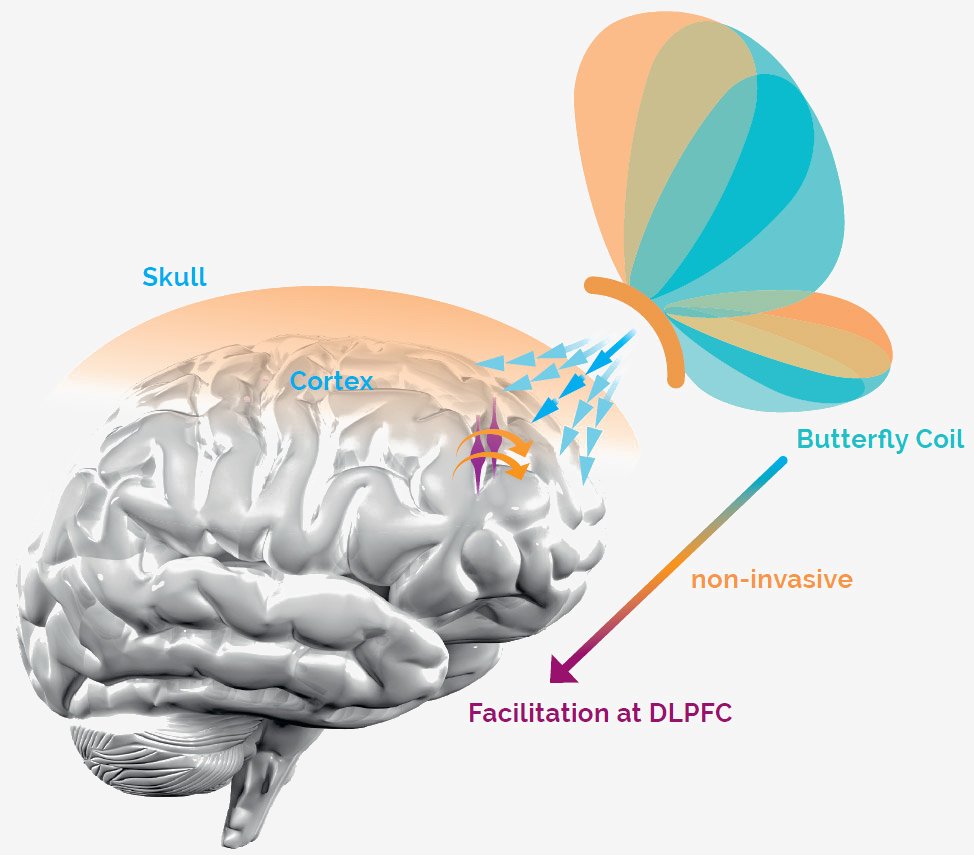 Ectron - TMS, Depression, Neurological, Rehabilitation, ECT