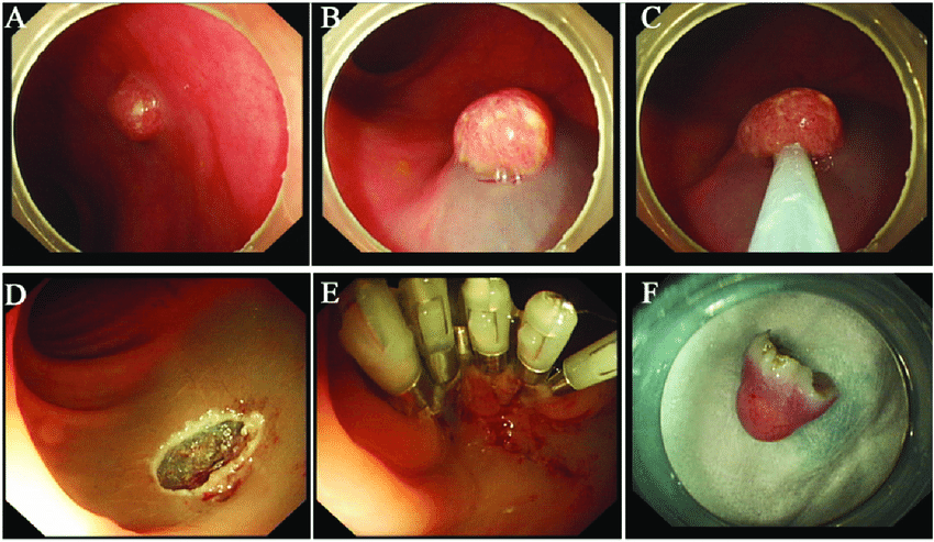 Third Space Endoscopy and Endoscopic Resection