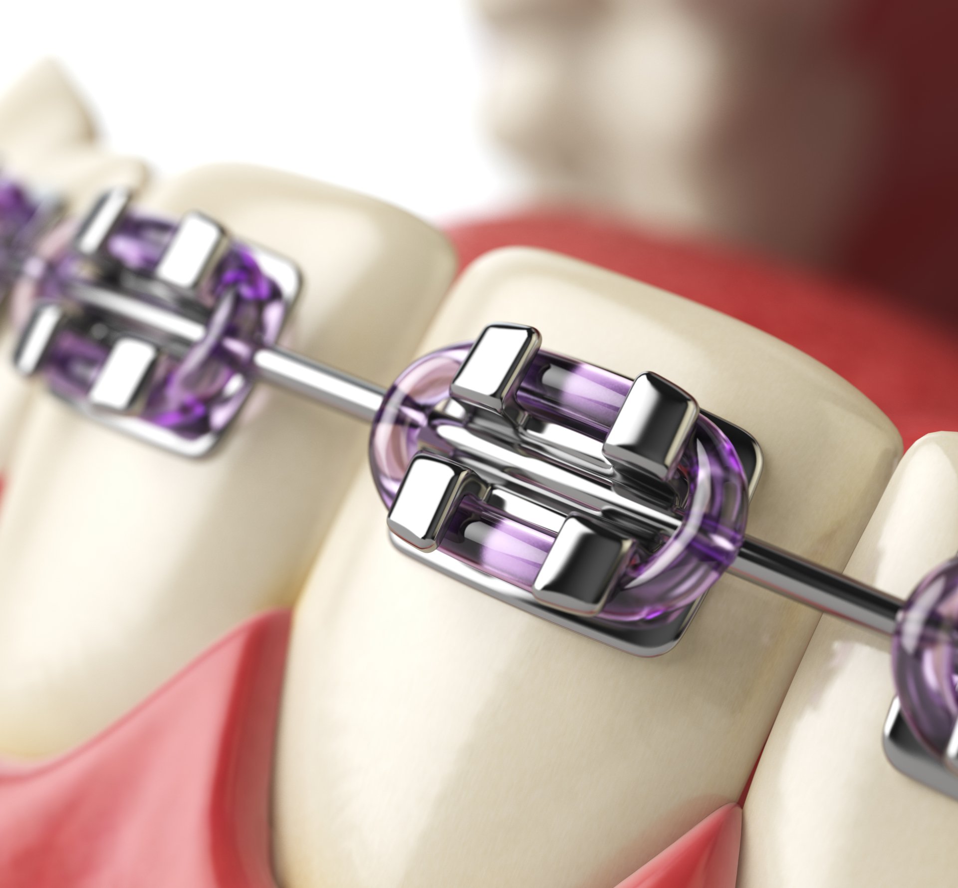 Traditional or Clear Braces | Dr.Sema & Dr. Stewart