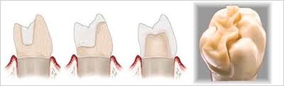 Próteses de cerâmica Inlays e Onlays