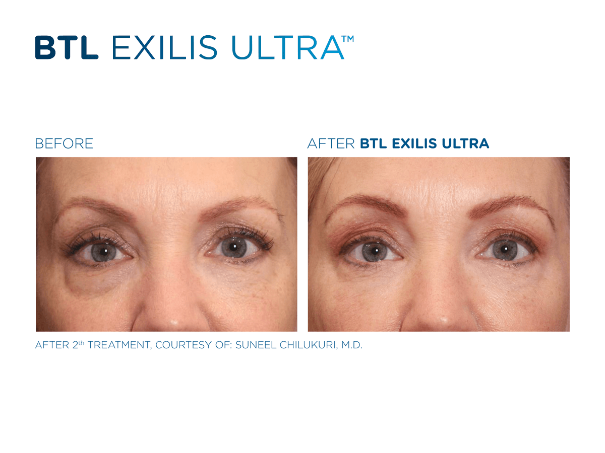 Exilis 360 - Body Sculpting, Skin Tightening,