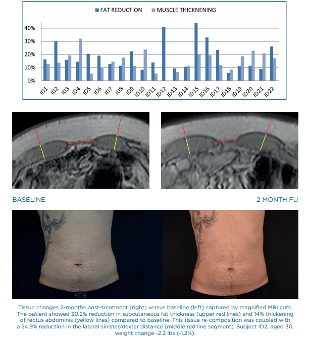 MAGNETIC RESONANCE IMAGING (MRI) STUDY: SIMULTANEOUS FAT AND MUSCLE EFFECT