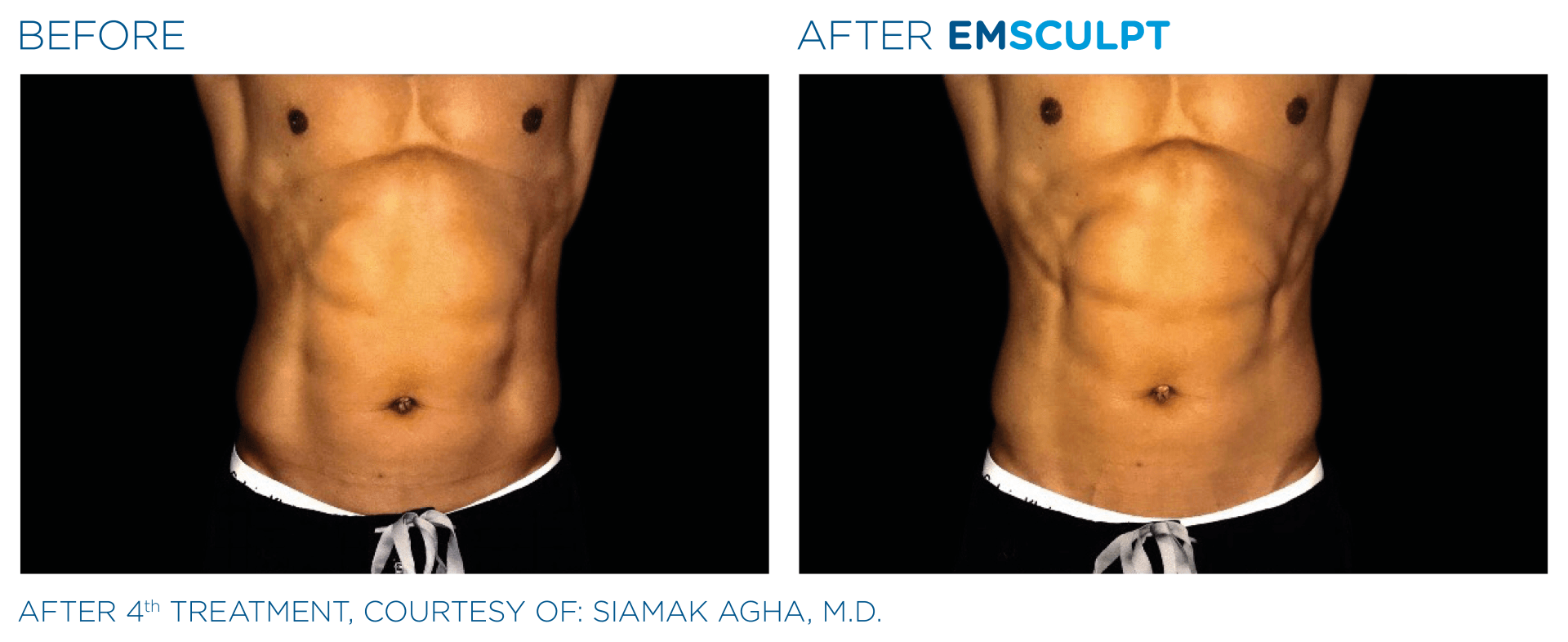 EMSCULPT Body Sculpting | Westerville, OH | Burn Fat