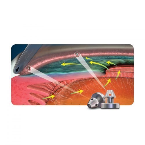 iStent inject W offers hope for those with glaucoma and cataracts