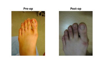 Lesser Toe Deformities