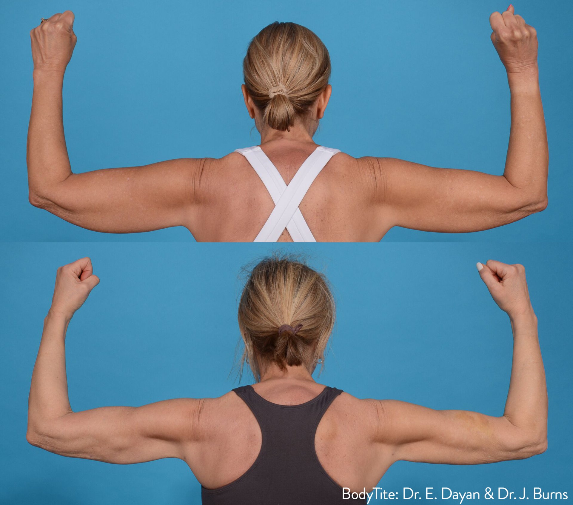 Bodytite Indianapolis Carmel | Less Down and Scar Amazing Body Shaping