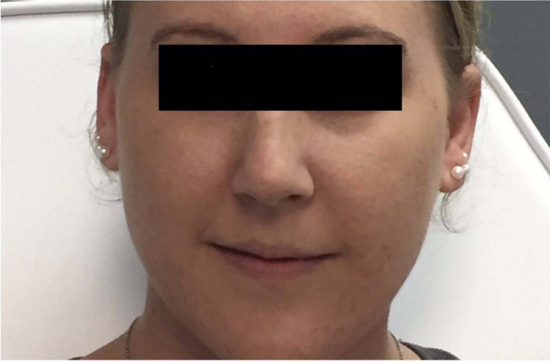 Laser Facials | Clear Skin | Steel Works Tattoo & Laser