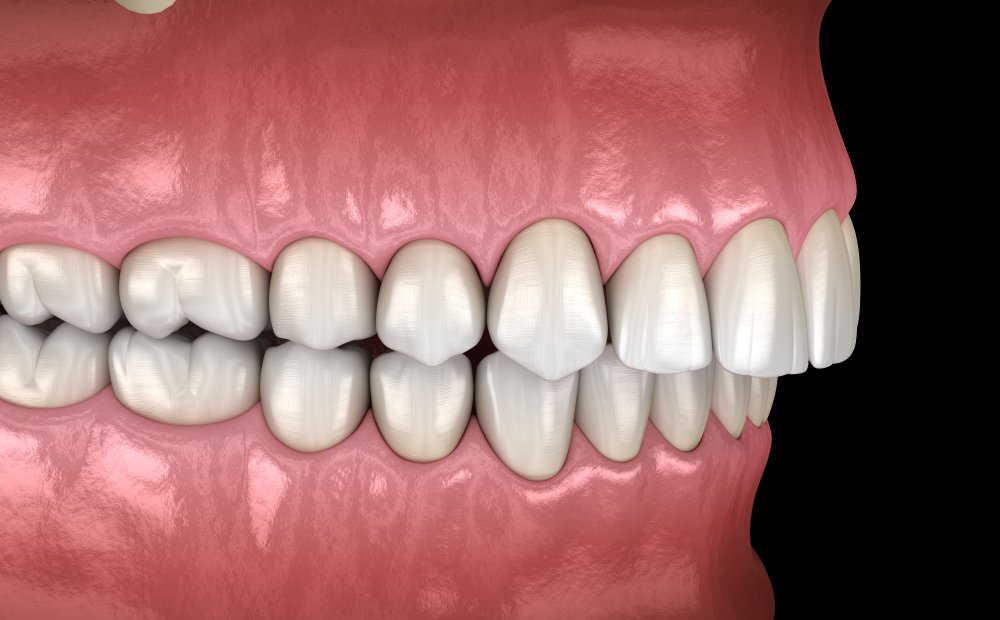 What Is An Overbite How To Fix An Overbite Dr Kim Orthodontist