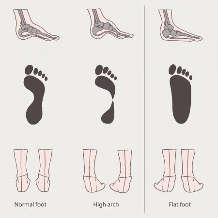 Over-Pronation (Flat Feet) | Foot & Ankle Rehab Clinic | Nedlands