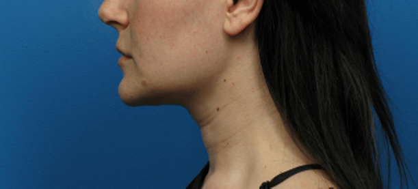 Genioplasty Surgery - Chin Surgery or Implant Surgery