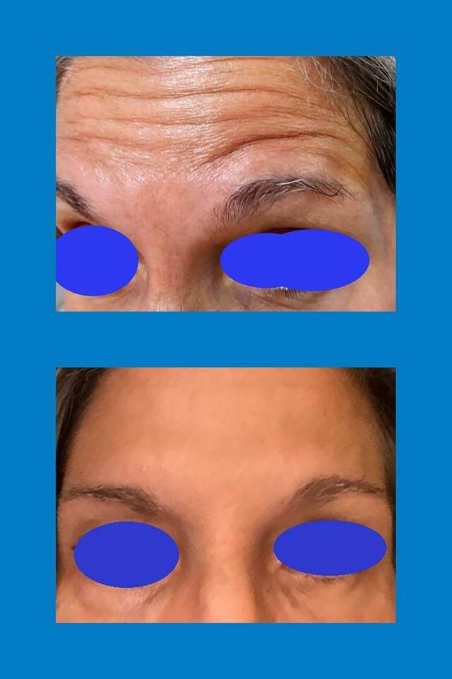 Θεραπείες Botox Προσώπου & Σώματος - facedermaclinic