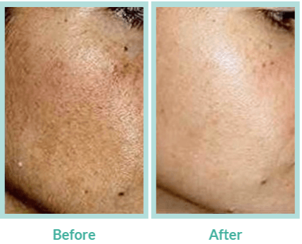 Facial Peels | Casper, WY | SkinCare by Vondi