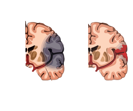 Tipos de ACV ? Conocerlos es vital para su tratamiento 👨‍⚕️