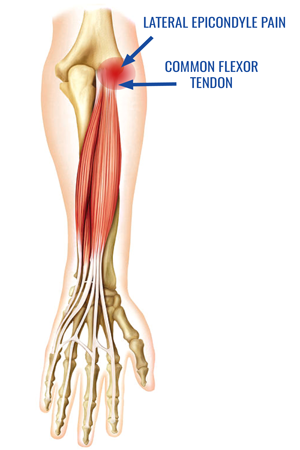 Dr David Samra | Sports Medicine Specialist | Tennis Elbow