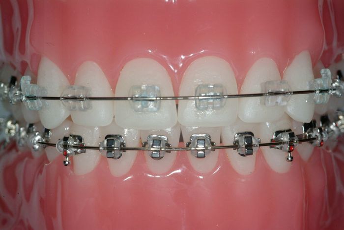 World Class Smiles! - Erickson Orthodontics